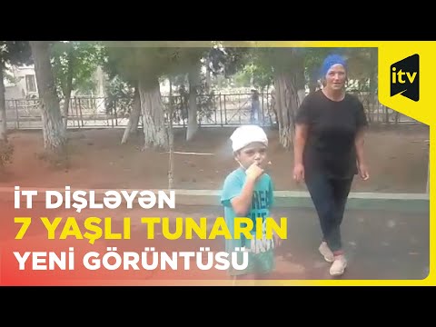 Sumqayıtda it dişləyən 7 yaşlı Tunarın yeni görüntüsü İTV-də