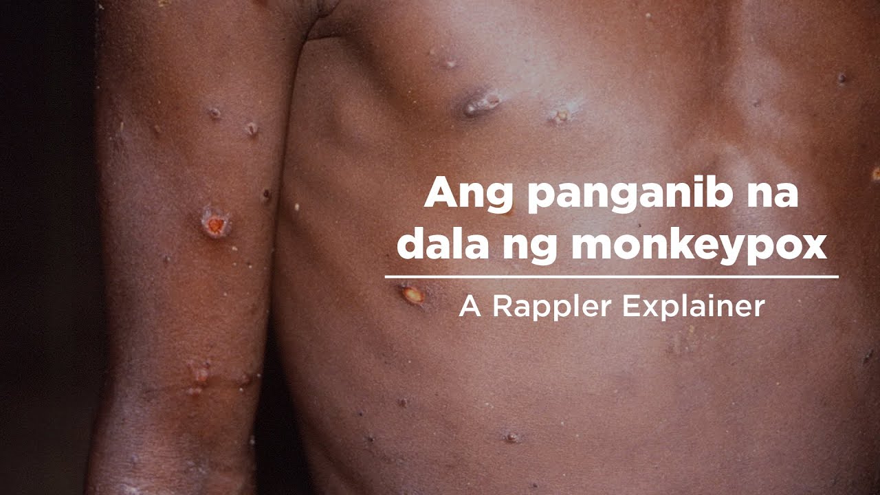 EXPLAINER: Ang panganib na dala ng monkeypox - YouTube