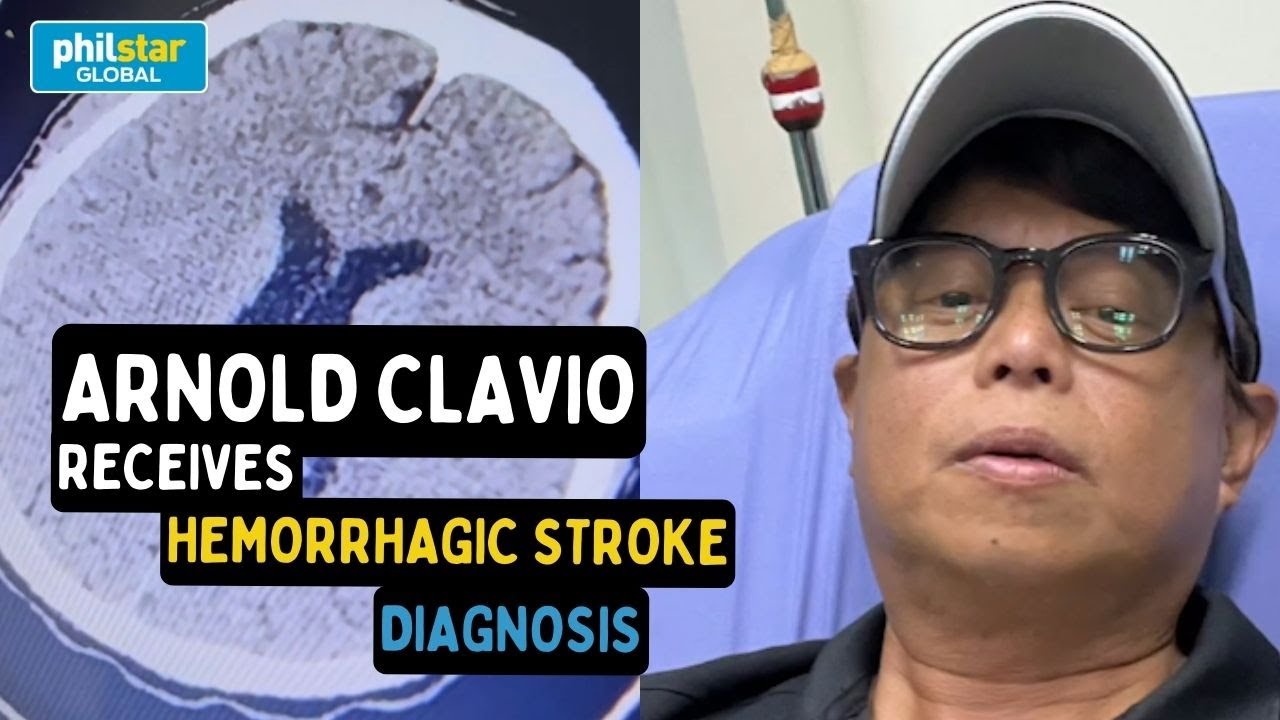 News Anchor na si Arnold Clavio nagkaroon ng “Hemorrhagic Stroke ...