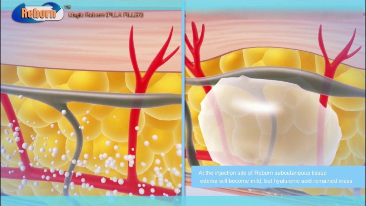 Injection PLLA Dermal filler - YouTube