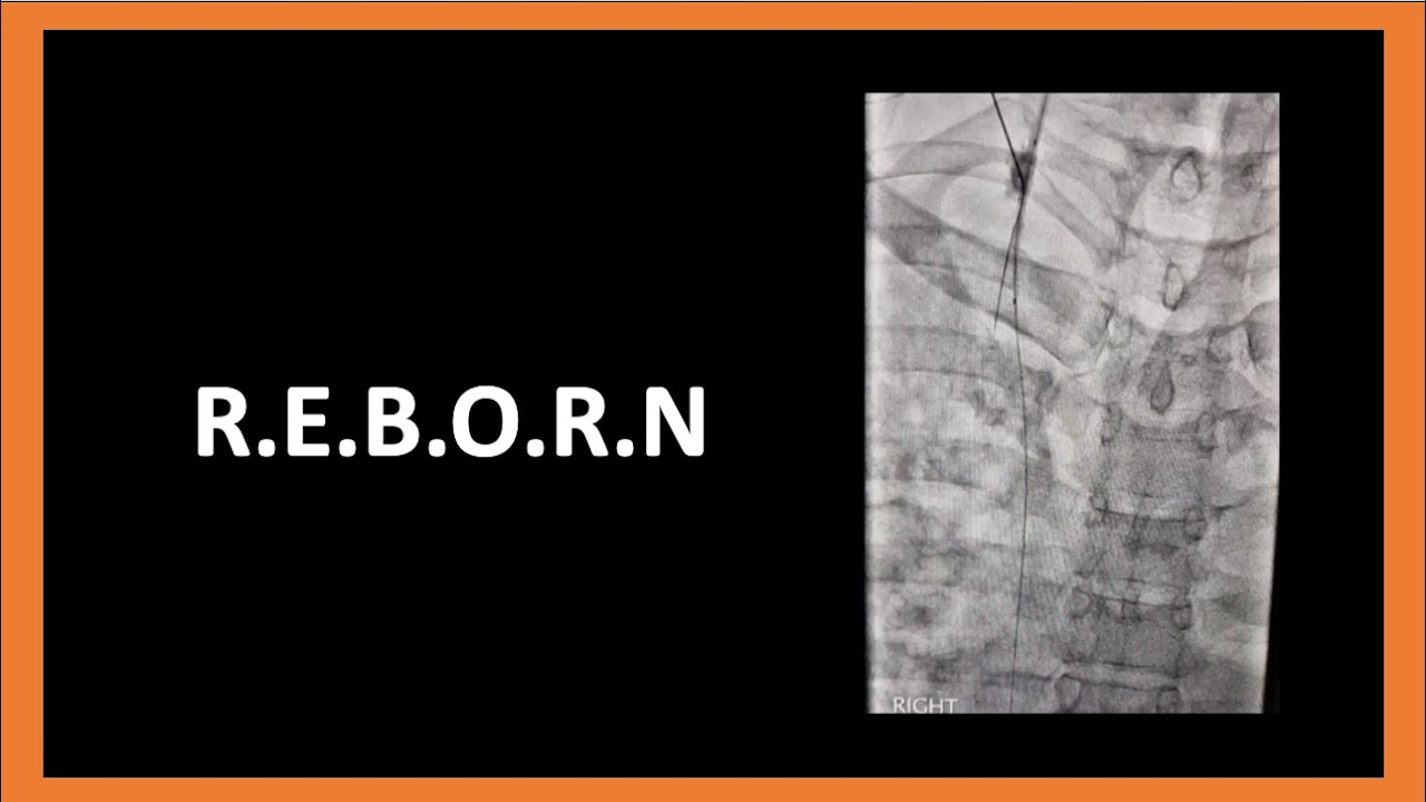 REBORN Line Insertion For Occluded Central Veins - YouTube