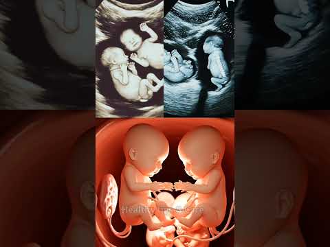 One Pregnancy, Two Precious Lives#twins #baby #pregnancy