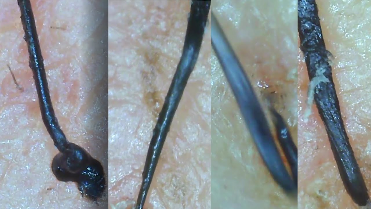 #014 Pull Out Beard (Blackhead Hair Root) (毛抜き 毛根 拡大 ひげ) - YouTube