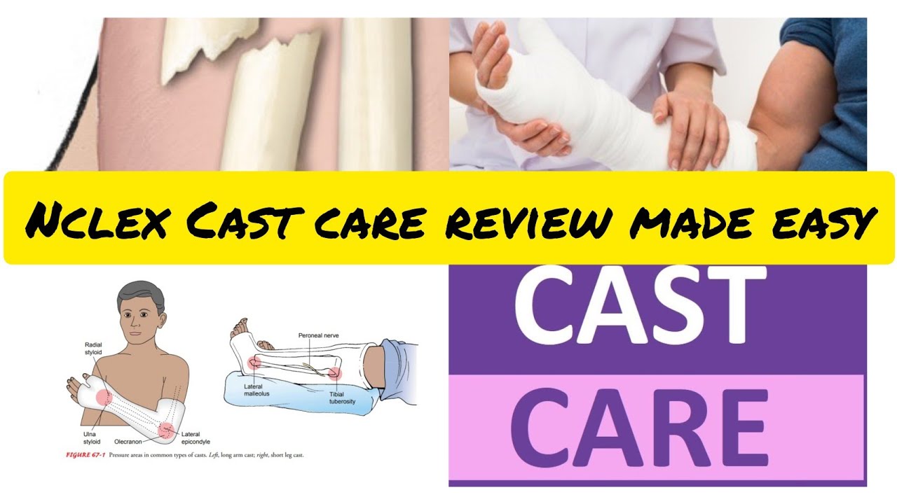 #Nclex Cast Care made easy. #kaplan #uworld. - YouTube