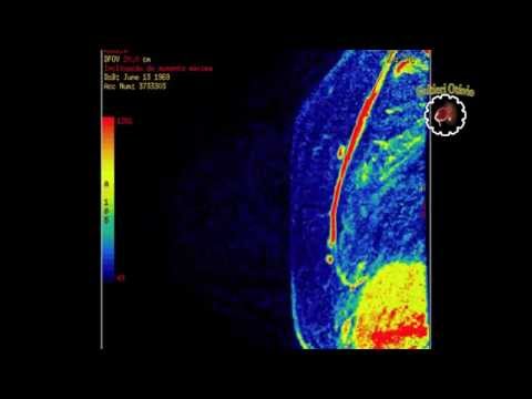 NÓDULO MAMÁRIO BI-RADS 6 - RESSONÂNCIA MAGNÉTICA - YouTube