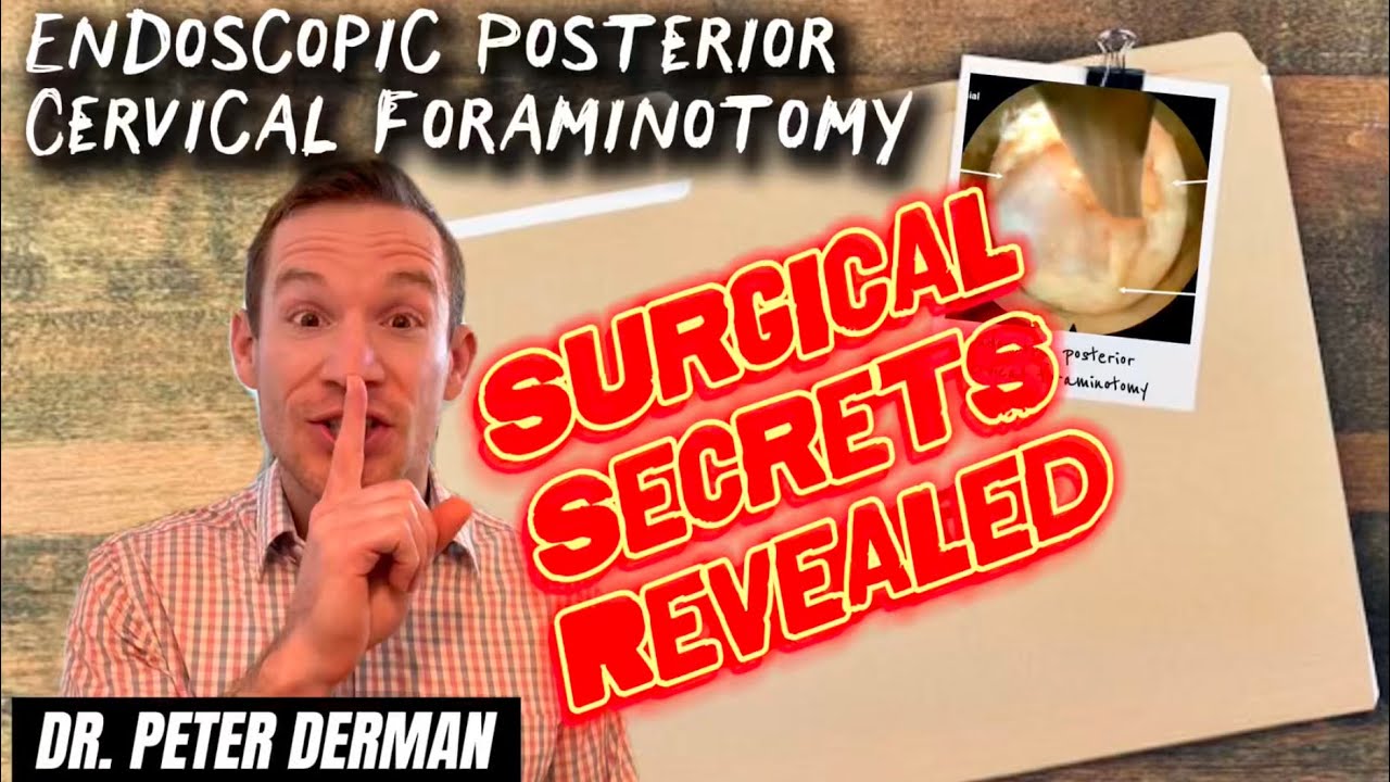 Endoscopic Posterior Cervical Foraminotomy: Surgical Secrets Revealed ...