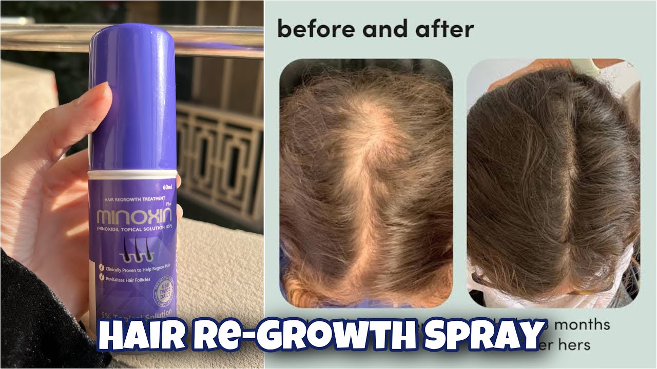 How to Use Minoxin Plus hair spray | Minoxidil For Hair Loss | Hair ...