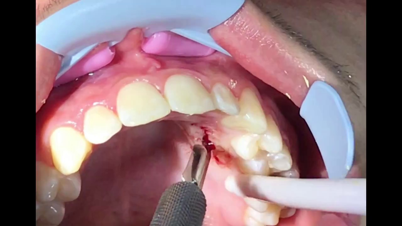 Single incision flap CTG - YouTube