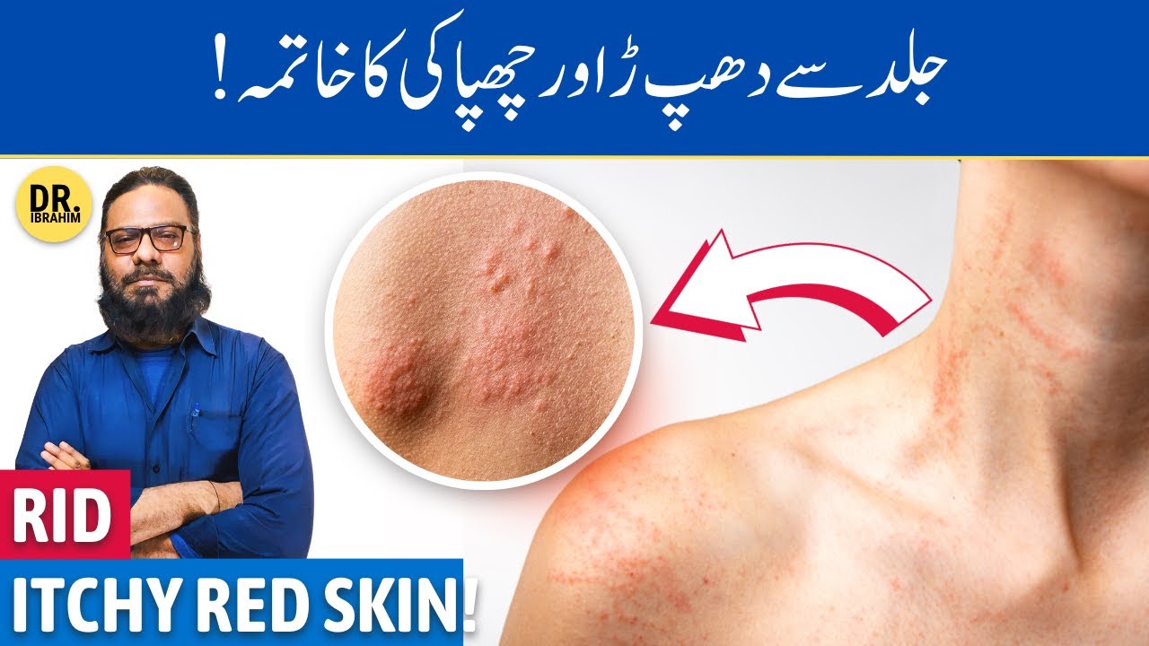 Kharish/Dhapper Ka Ilaj | Treat Urticaria/Hives on Skin | Dr. Ibrahim ...