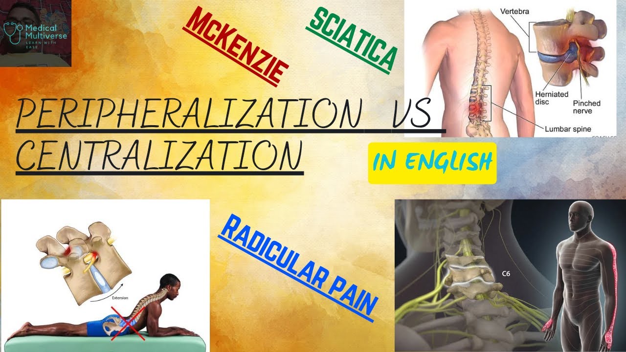 Peripheralization VS Centralization in English | Radicular Pain ...