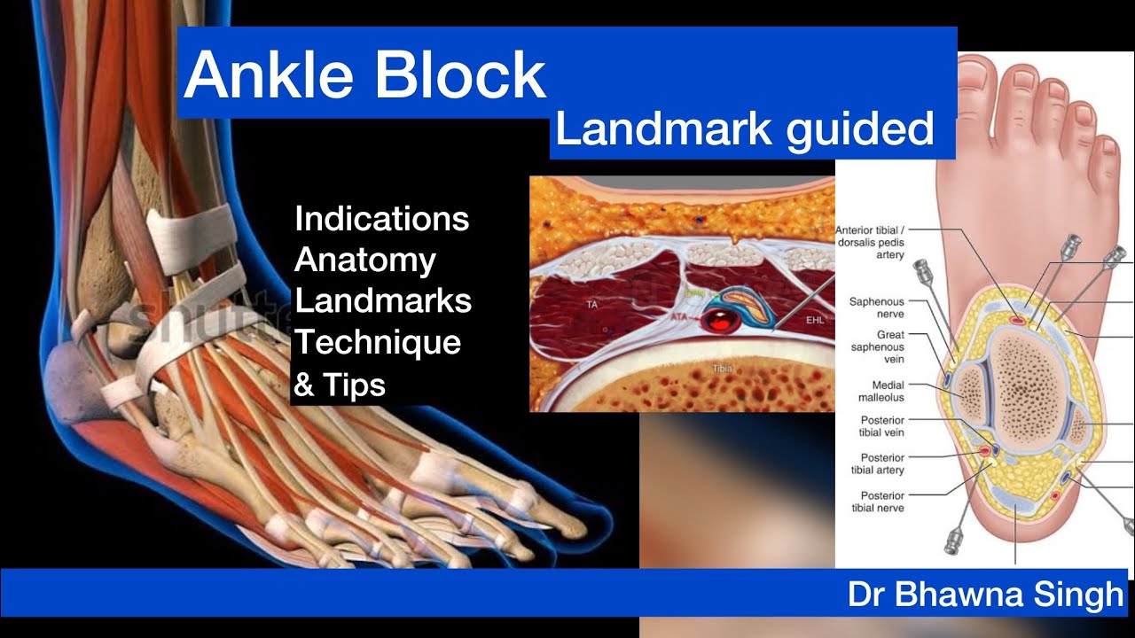 #Landmark guided #Ankle Block simplified #regional#anesthesia #latest # ...
