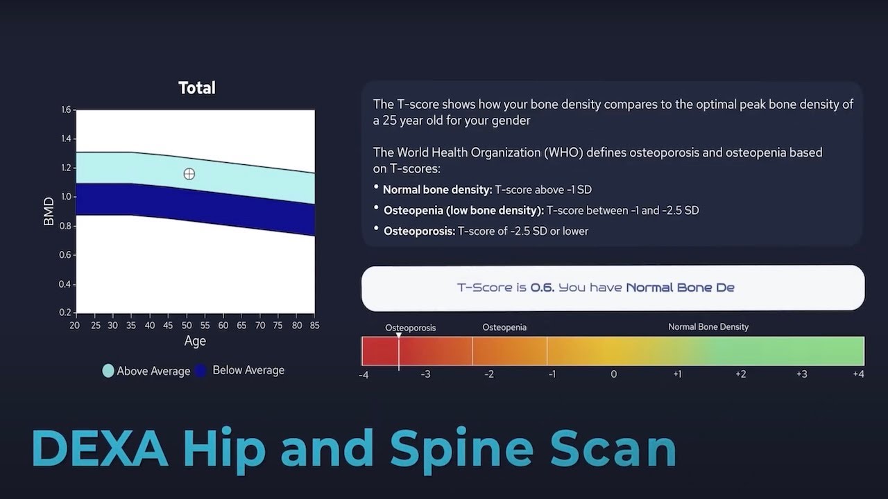 BodyView Osteoporosis Dexa Scan - YouTube