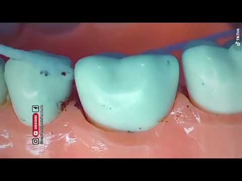 ¿CÓMO limpia el hilo dental entre las muelas?