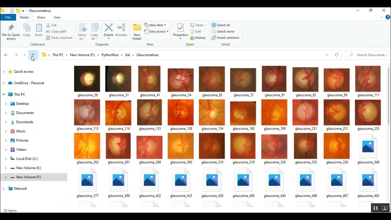 Glaucoma Detection using Mask Region Based Convolutional Neural Networks - YouTube