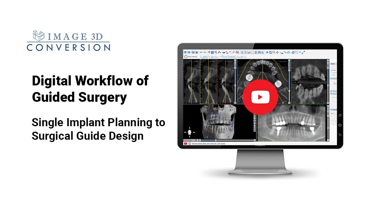 Digital Workflow of Guided Surgery - Single Implant Planning to ...