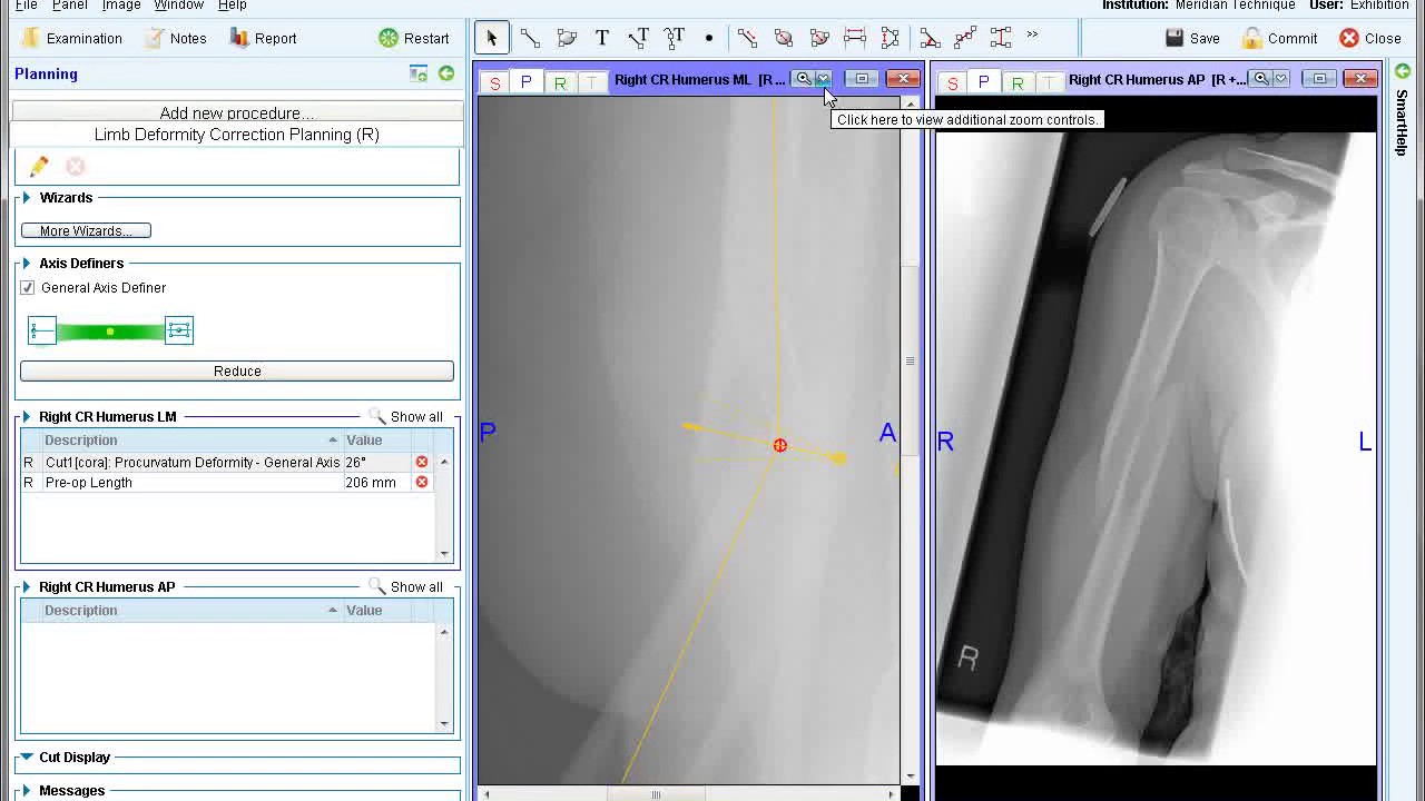 Upper Limb or Long Bones | Deformity Correction Planning | Materialise ...