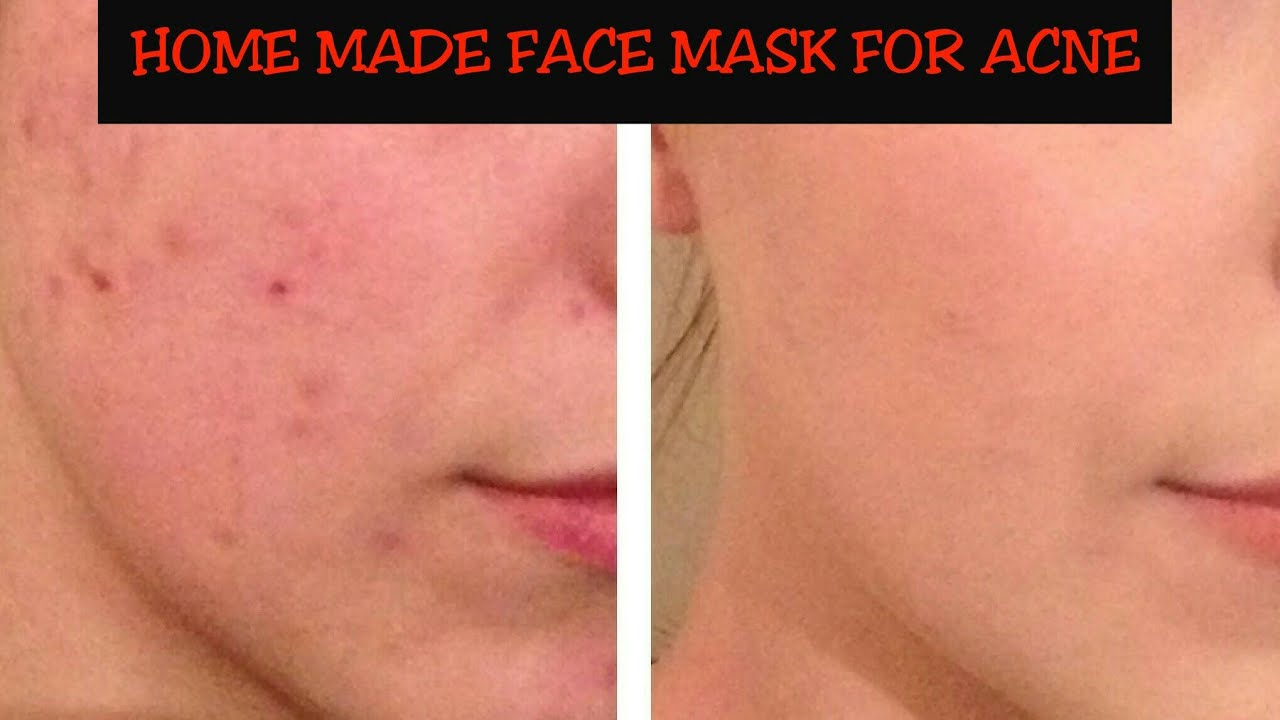 Most Effective Face Mask For Acne || Get Clear Bright and Acne free ...