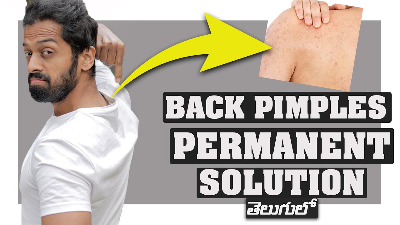 HOW TO REMOVE BACK PIMPLES NATURALLY (7 remedies) - YouTube