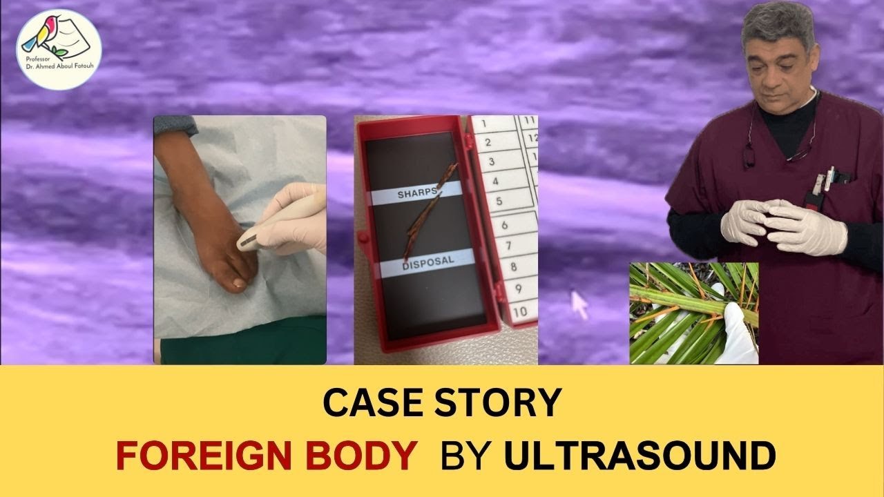 Foreign body by Ultrasound (pre & post extraction) - YouTube