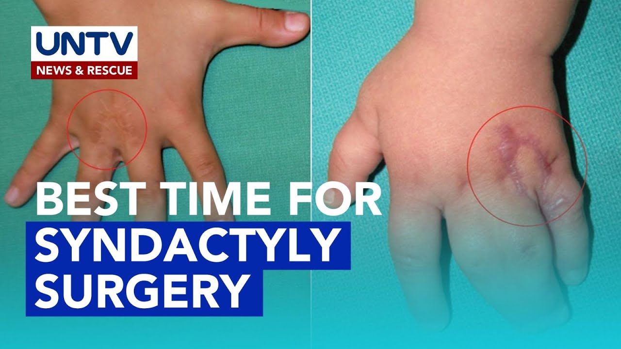 When should syndactyly be treated surgically? | Doctors on TV - YouTube