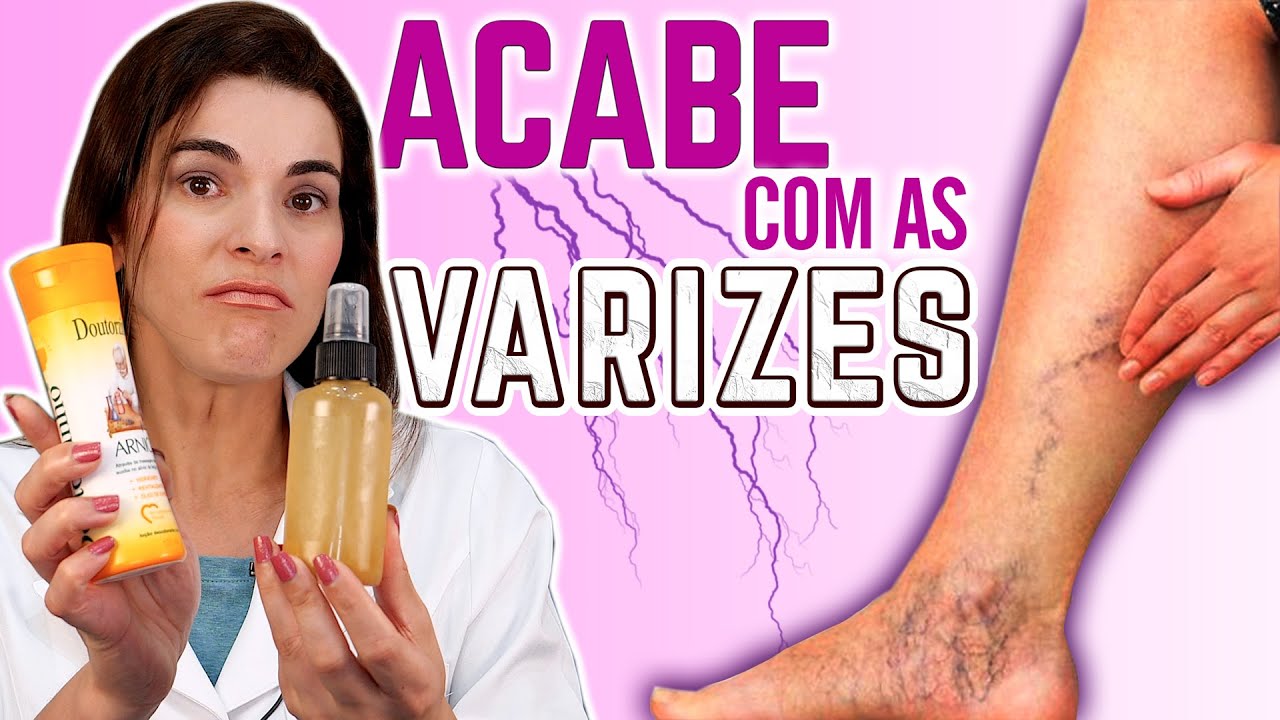 ACABE Com as VARIZES usando essa Receita e Dicas - YouTube