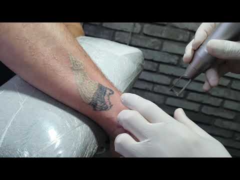 UZMANLIK ICIN DOVME SILME