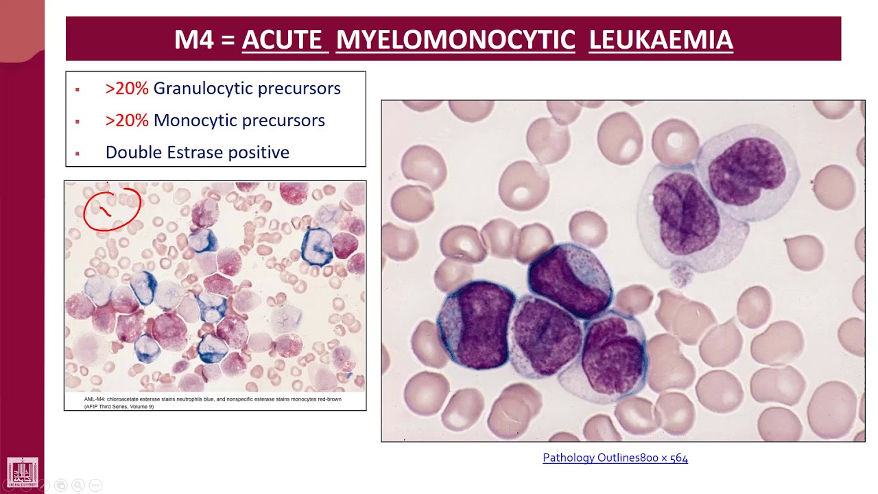 Hematology - 2 | U2-L26 | FAB classification of AML subtypes - 5 - YouTube