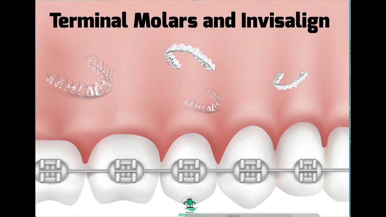 Terminal Molars and Invisalign- Tricks and Tips - YouTube
