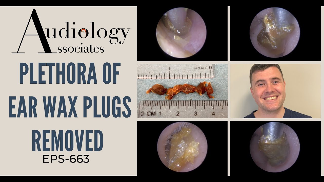 PLETHORA OF EAR WAX PLUGS REMOVED - EP633 - YouTube