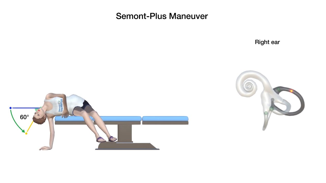 Semont-Plus Maneuver for Right Posterior Canal Benign Paroxysmal ...