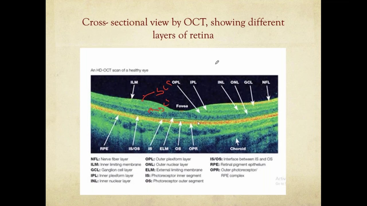 How to interpret an OCT- Dr.Anadi Khatri - YouTube