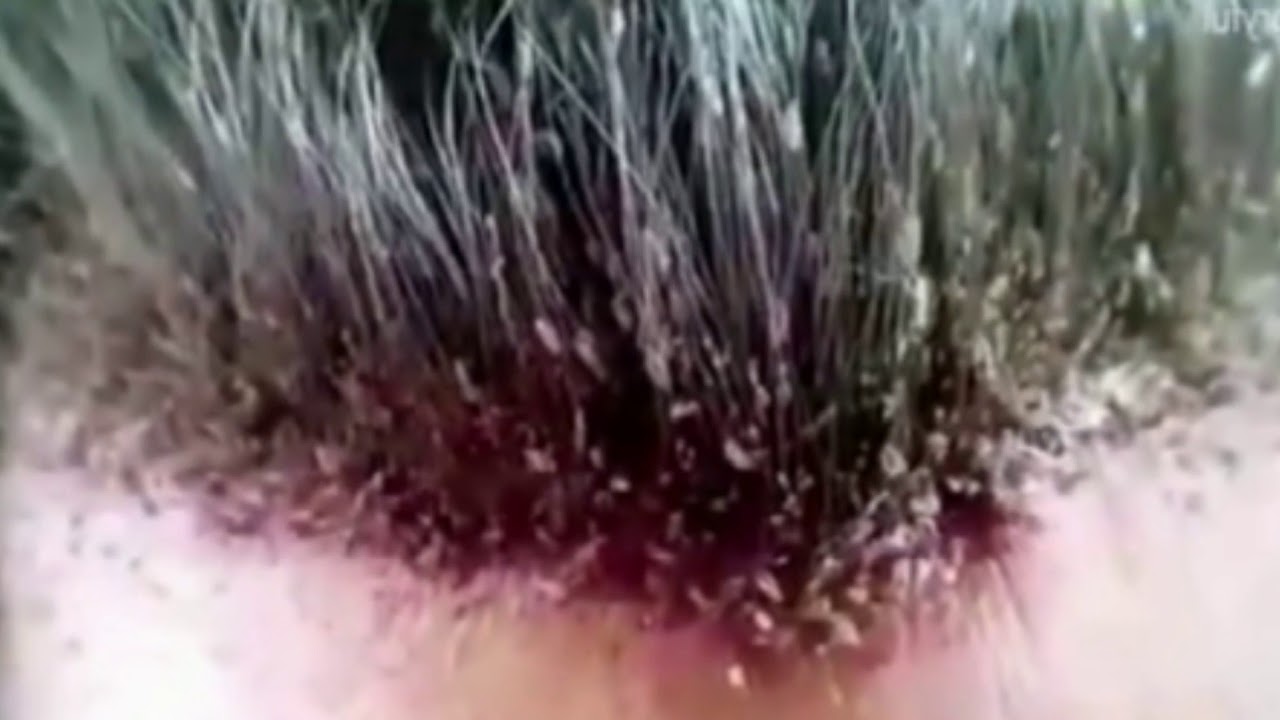 The most terrifying case of head lice ever: Stomach churning video ...