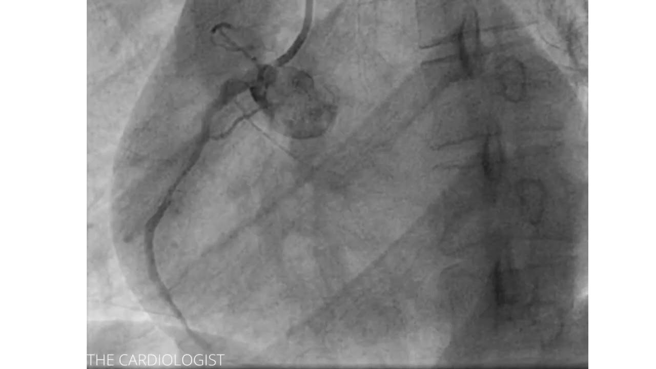RCA Stenosis and Spiral Dissection - YouTube