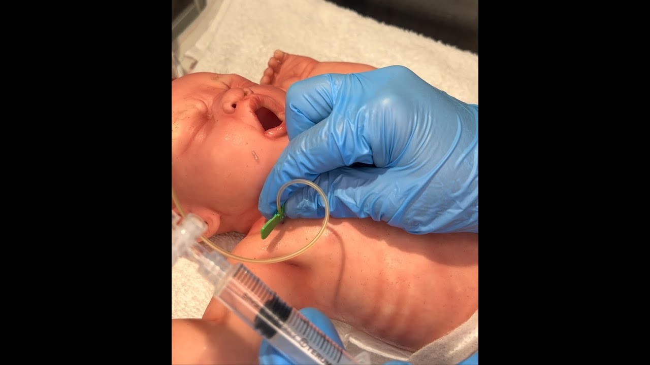 Neonatal Needle Thoracentesis with a Butterfly@McGlinnInstituteNeonatal ...