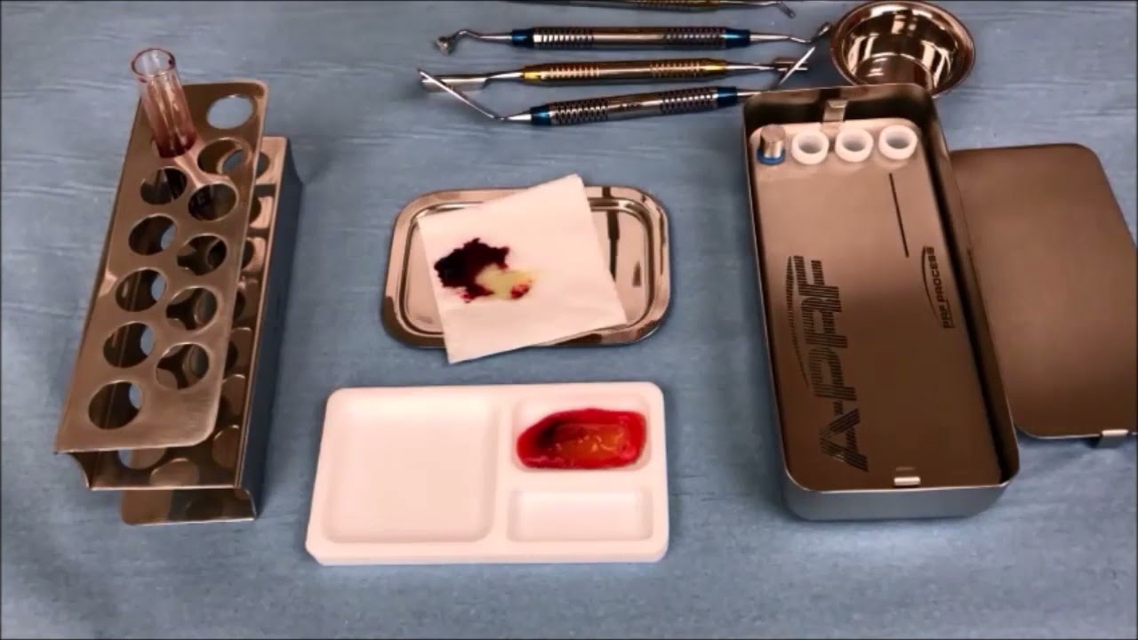 PRF Sticky Bone Technique - YouTube