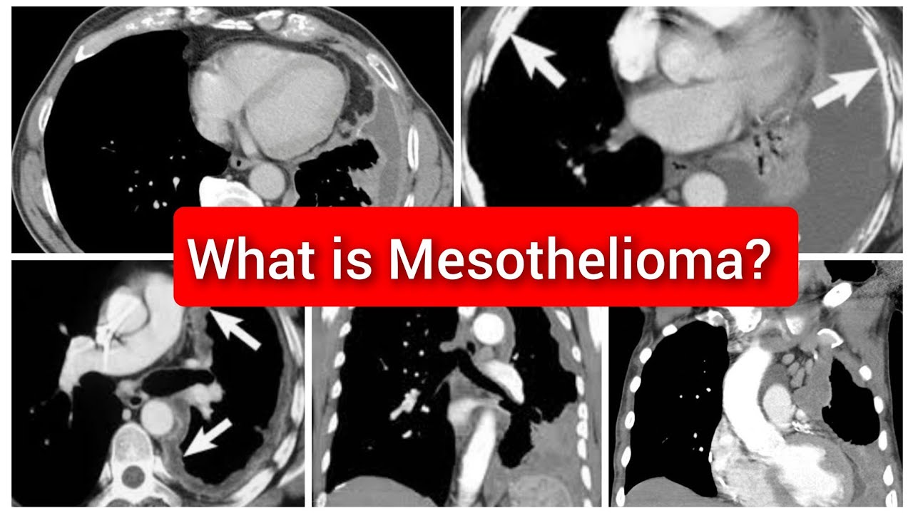 Mesothelioma of Pleura CT Chest - YouTube