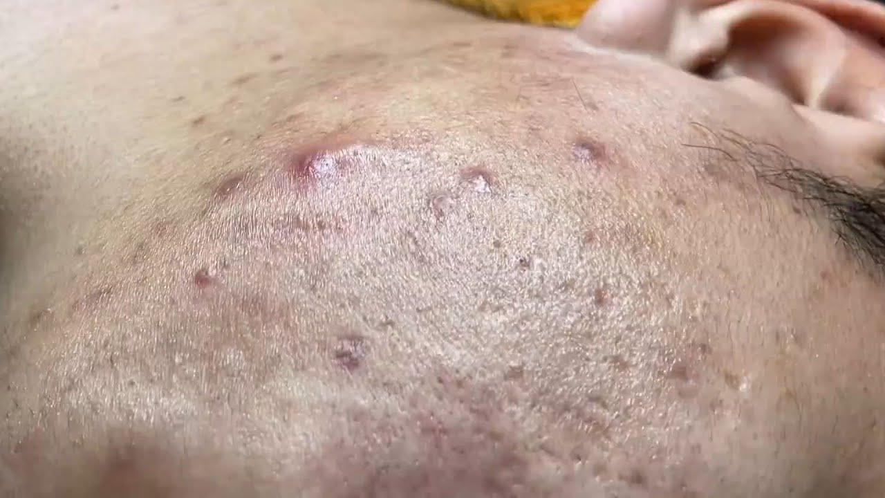 RELAXING WITH NASA SPA || SQUEEZE ACNE VIDEO #26 - YouTube