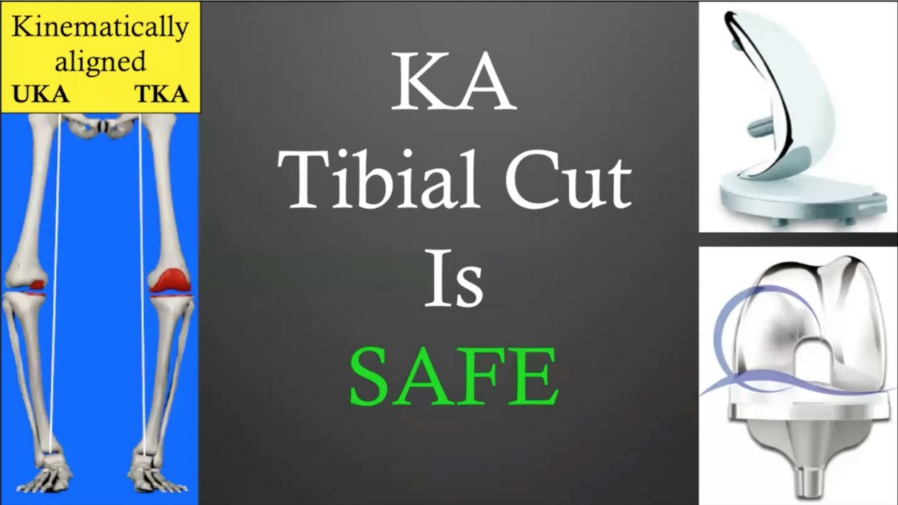 KA Tibial Cut Is Safe - YouTube