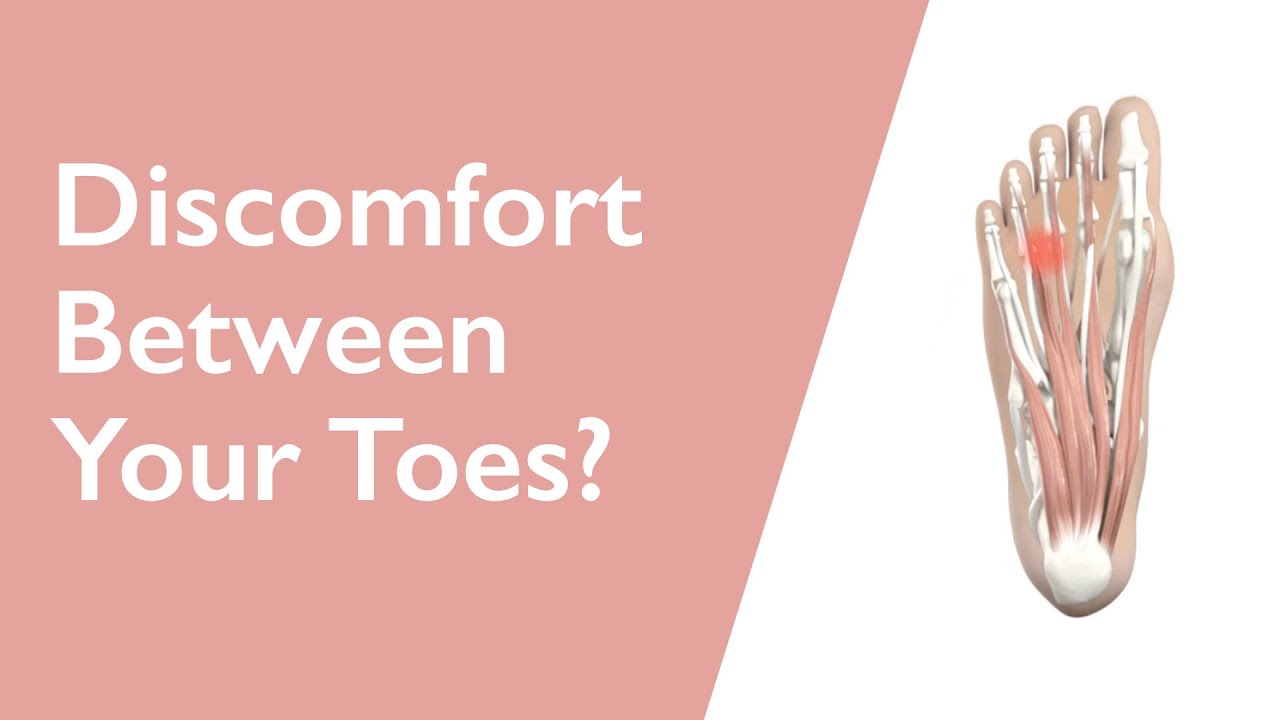 Morton's Neuroma: Causes & Orthotics - YouTube