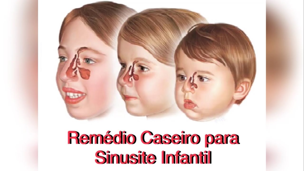 Remédio Caseiro para Sinusite Infantil - Dicas e Truques - YouTube