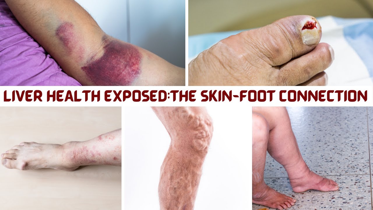 Liver Health Exposed: 15 Mind-Blowing Clues on Skin and Feet for ...