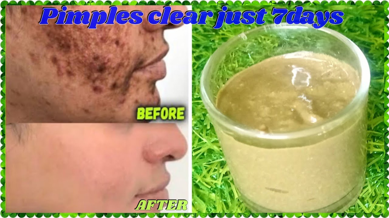 Pimples clear just 7 days/pigmentation scars cure face pack/crystal ...