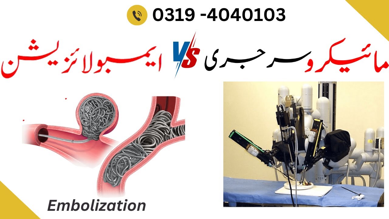 Varicocele Embolization Or Microsurgical Varicocelectomy Health