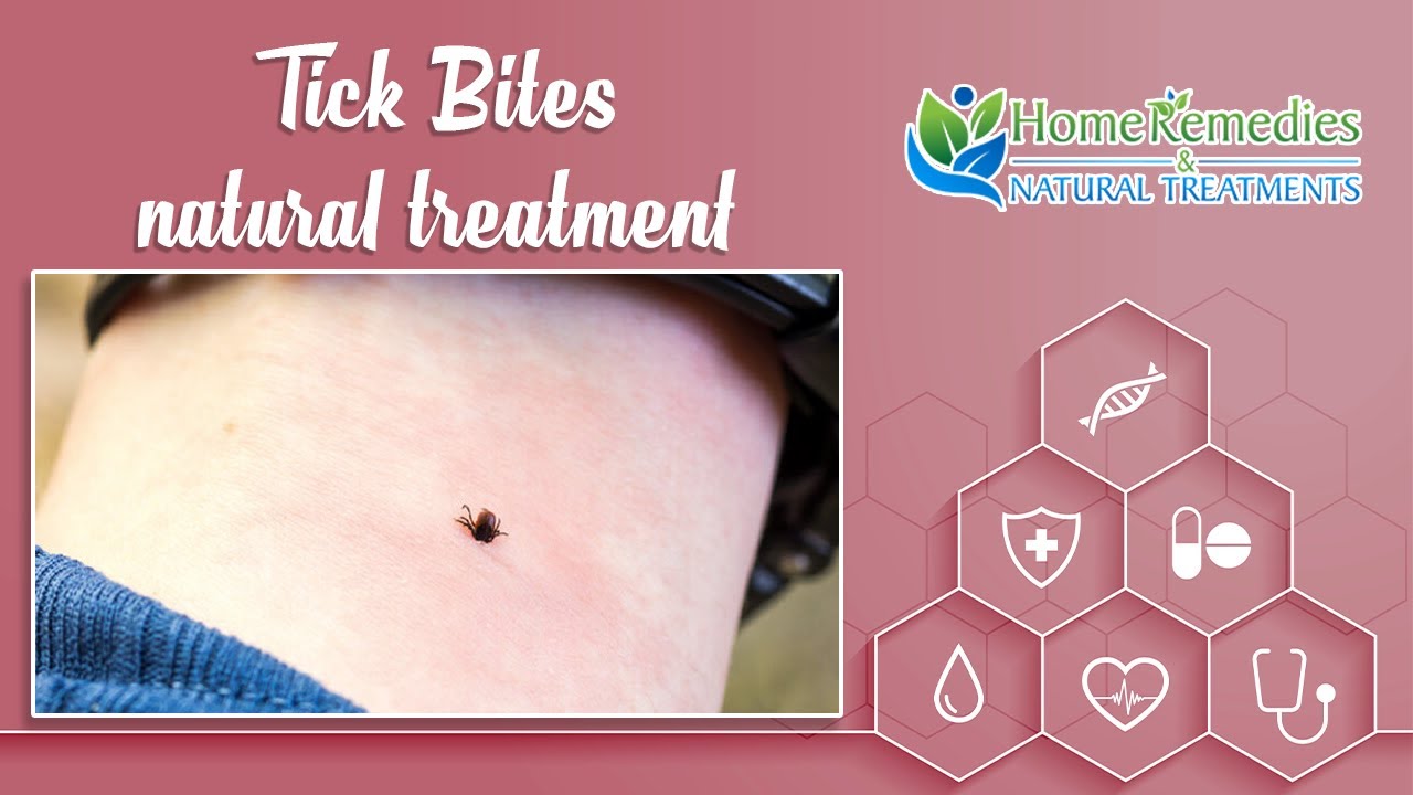 Natural treatments and home remedies for tick bites. - YouTube