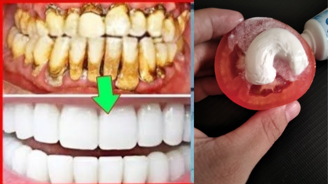 Teeth Whitening At Home In 2 Minutes || How To Whiten Yellow Teeth ...