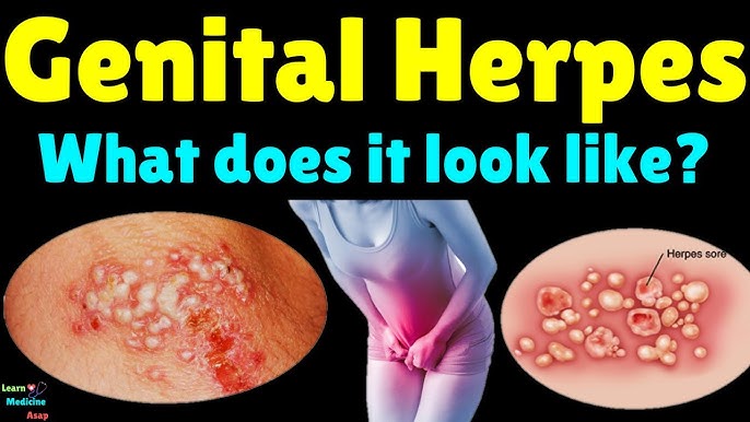 Herpes Genital Female Genital Herpes Sign Female Genital Sores: