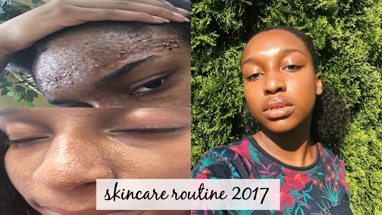 HOW I CLEARED MY SKIN! (Skincare Routine) | Coco Chinelo - YouTube