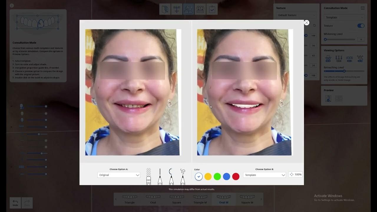 Stomatologie 3D & Smile Design fatete dentare Emax by Dr Catrinel Banu la Inside Clinic! - YouTube