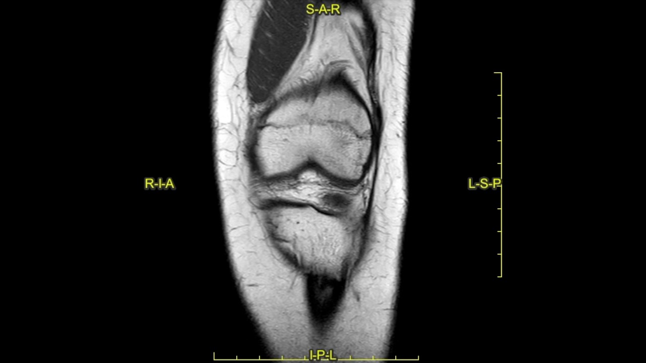 Early fatty replacement of bone marrow - complete MRI examination - YouTube