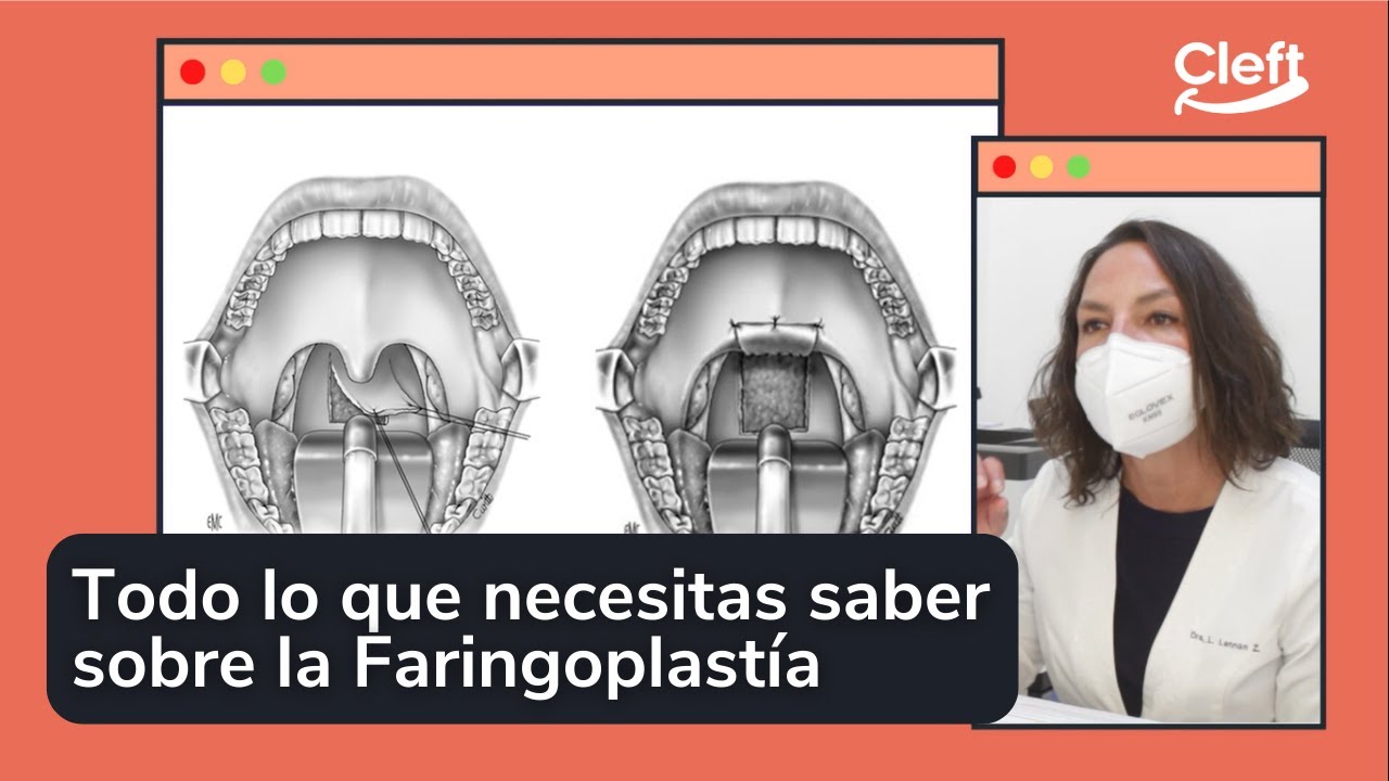 Todo lo que necesitas saber sobre la faringoplastía - YouTube